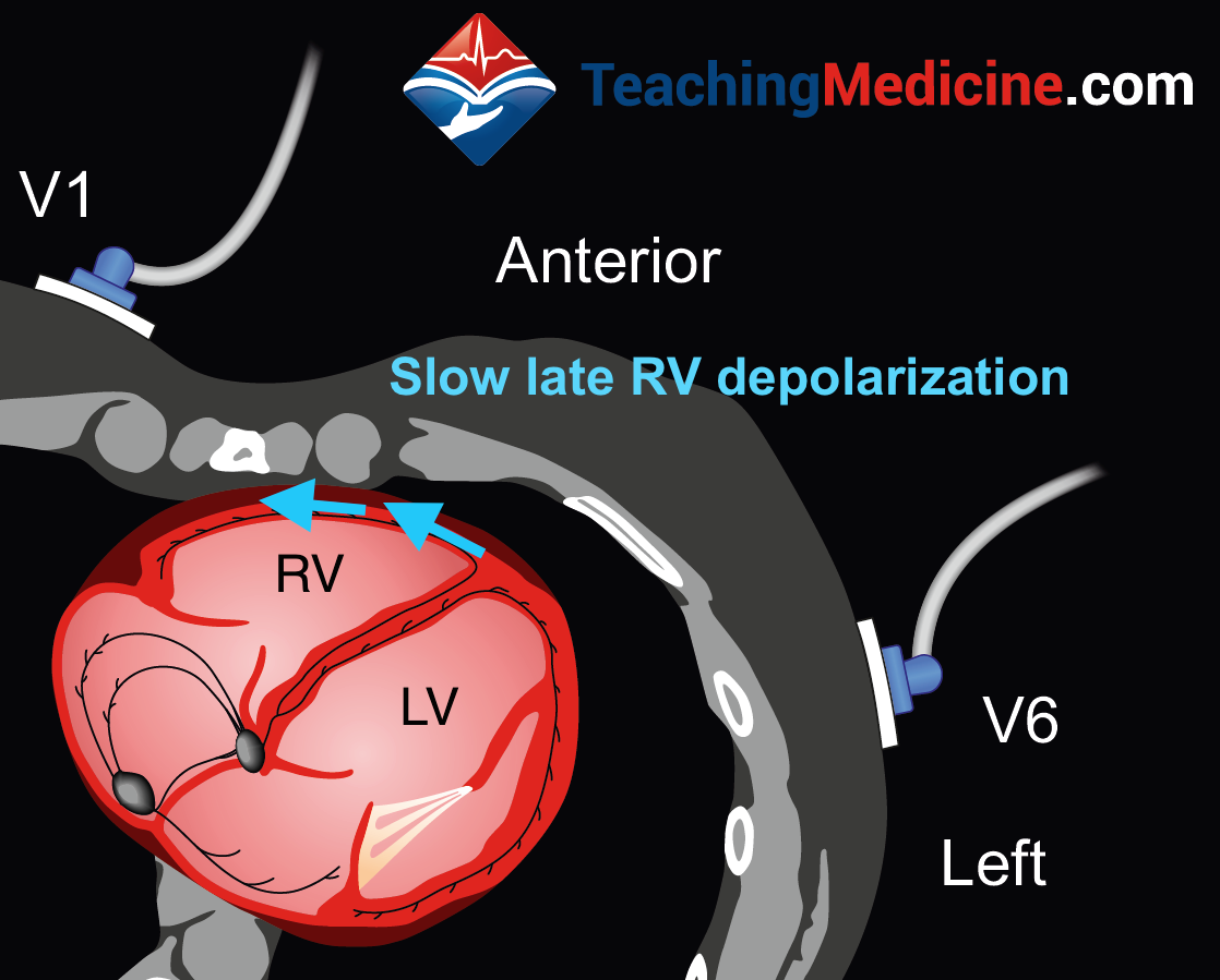 Teaching Medicine - Tutorial: Bundle Branch Blocks